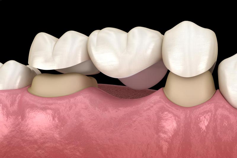 3 Tooth Bridge Cost UK: Ultimate Guide to Types & Prices
