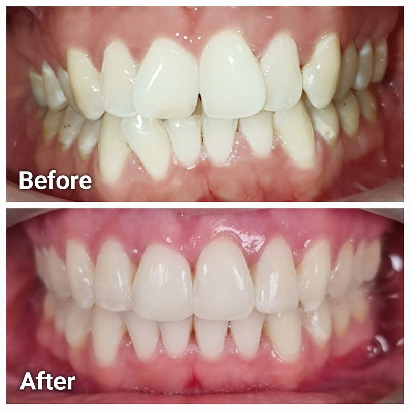 Invisalign Before and After Worst Cases: Gaps & Misalignments Fixed