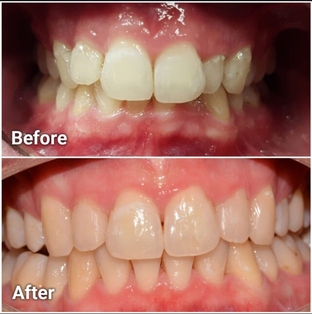 Invisalign Before and After Worst Cases: Gaps & Misalignments Fixed