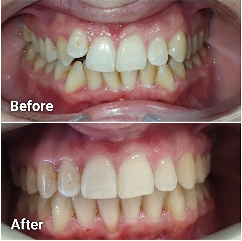 Invisalign Before and After Worst Cases: Gaps & Misalignments Fixed