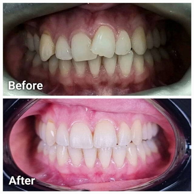 Invisalign Before and After Worst Cases: Gaps & Misalignments Fixed