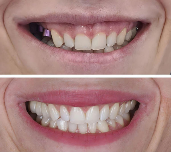 Can Invisalign Fix Overbite? Real Before and After Results