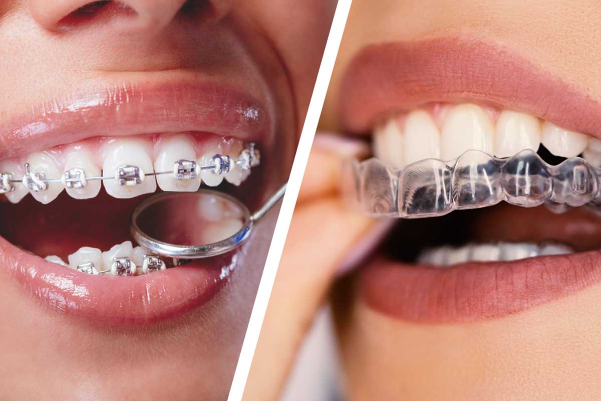 Invisalign Braces