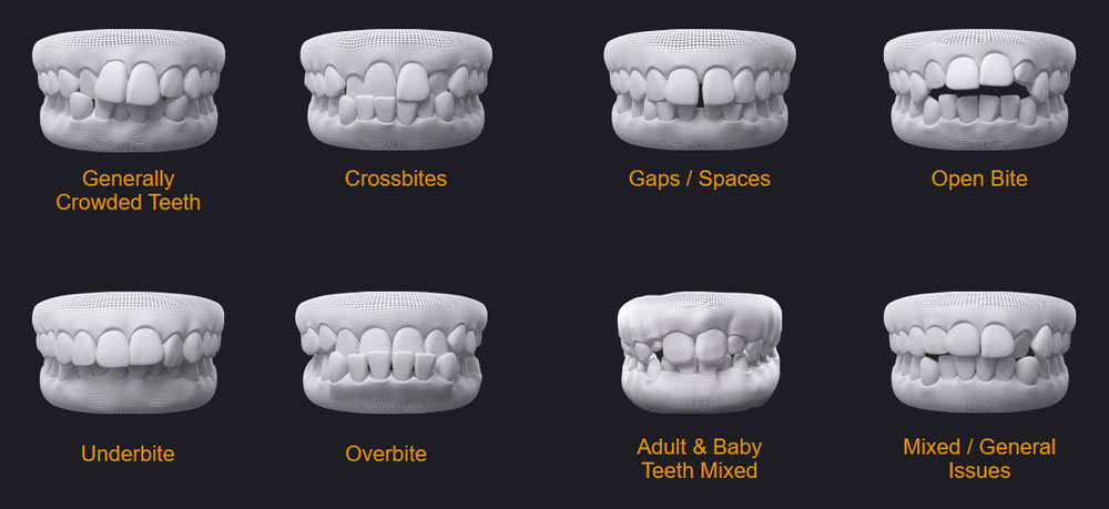 What Is Invisalign and How Does Invisalign Work?